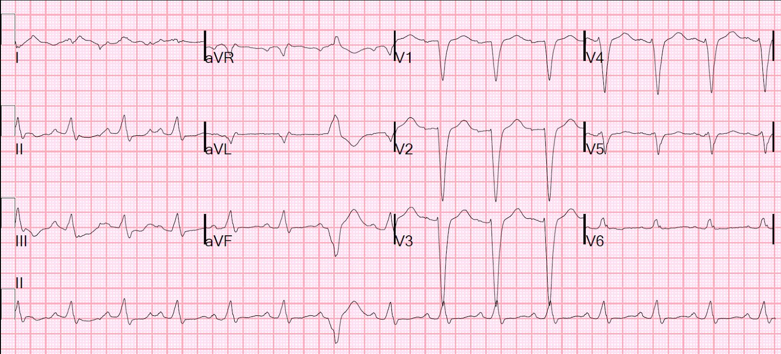 Dr. Smith's ECG Blog: Wide Complex Tachycardia Refractory to Anti ...