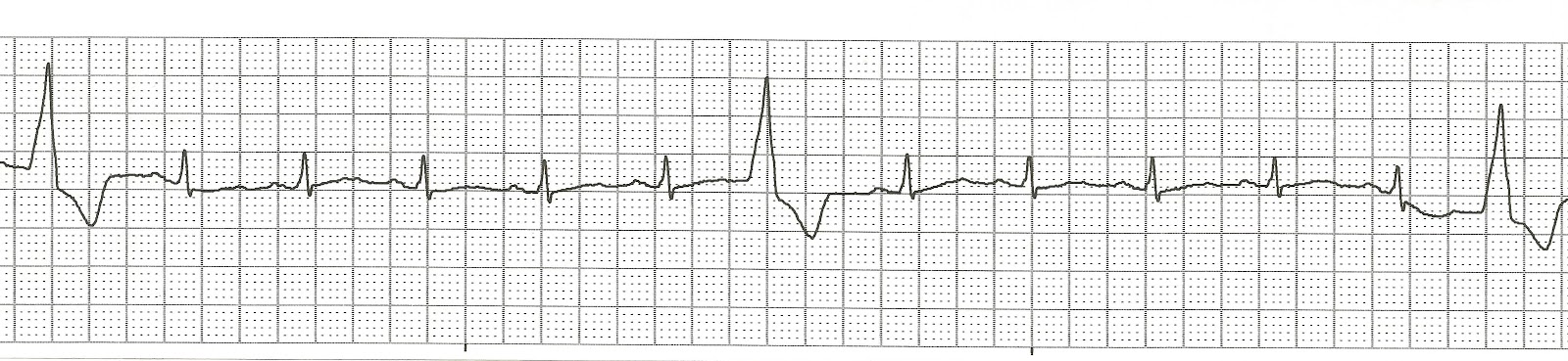 EKG Rhythm Strips 81: Bigeminy, Trigeminy, Quadrigeminy...
