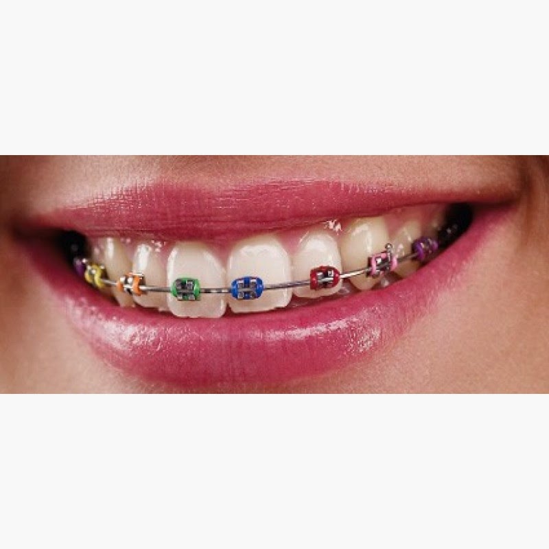 Tipos de brackets., sabes cuales son?