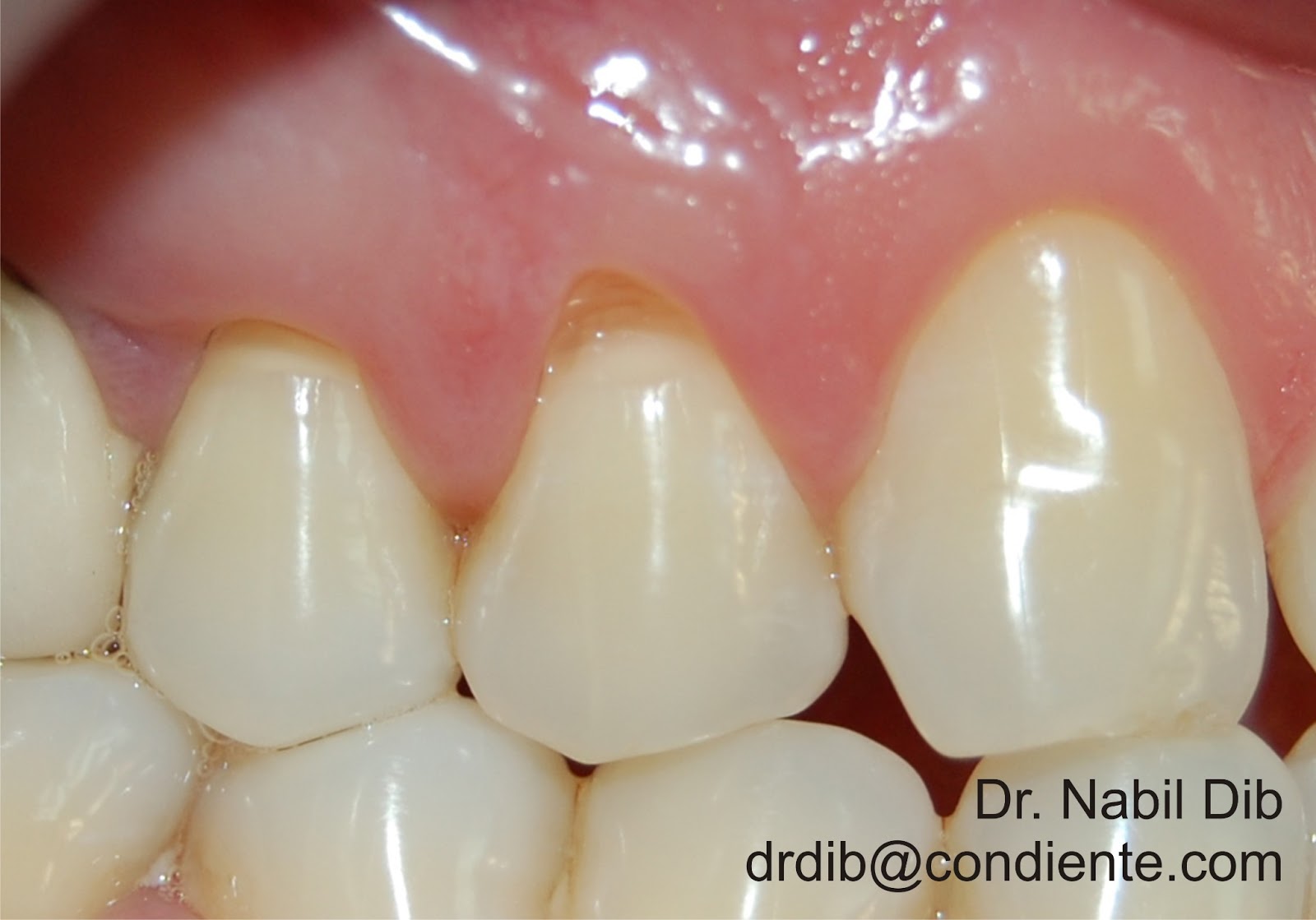 Dr. Nabil Dib: Restauraciones Clase V con Resina FILTEK Z350 3M ESPE