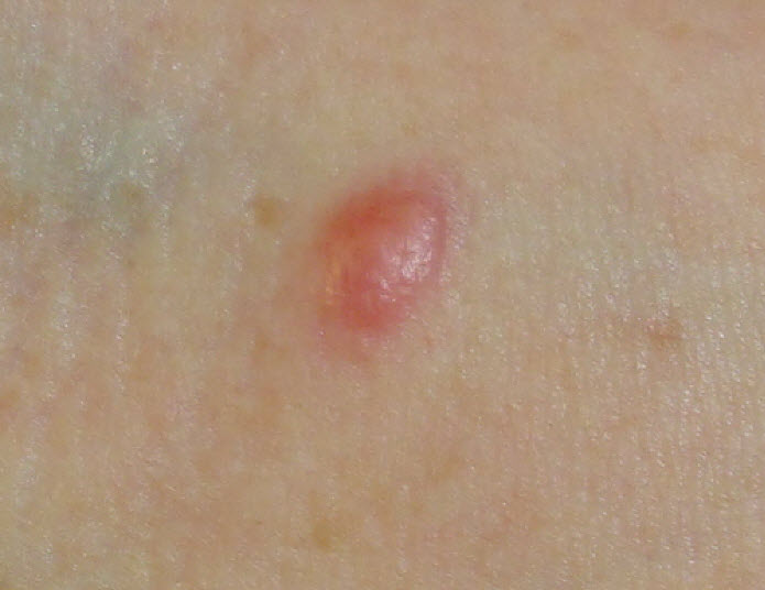 Consultations in Dermatoscopy: Pink and Purple