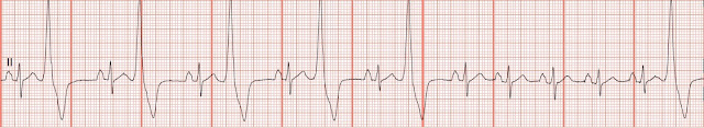 EKG Rhythm Strip Quiz 26