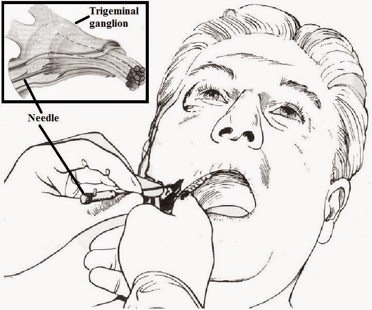 Medical Treatment Pictures-for Better Understanding: Glycerol Injection ...