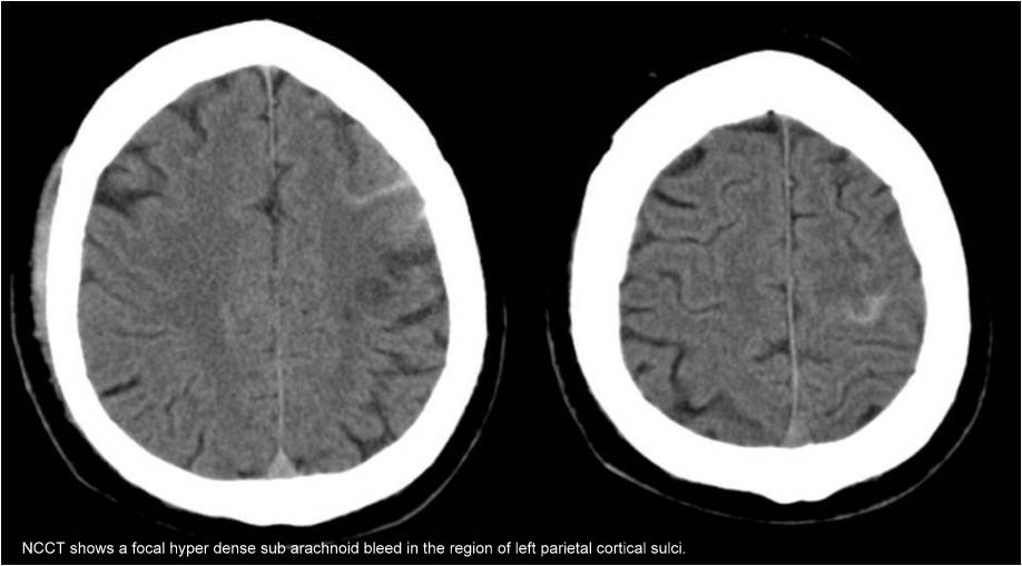 Dr Balaji Anvekar FRCR: Imaging in Sub Arachnoid H'rhage