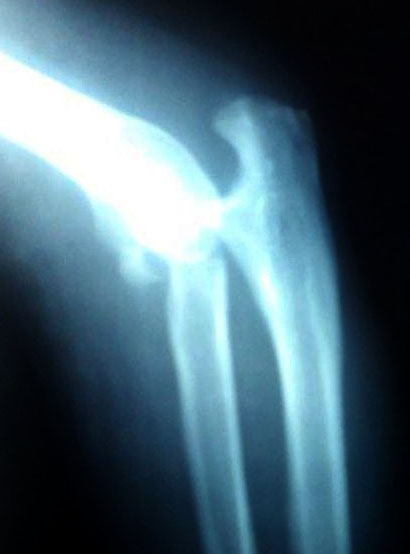 O R T O C R I T I C A: Fractura de cabeza radial asociado a ...