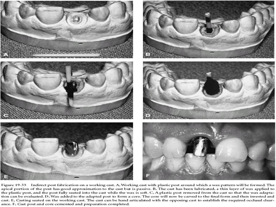Dentistry: Restoration of Endodontically Treated Teeth