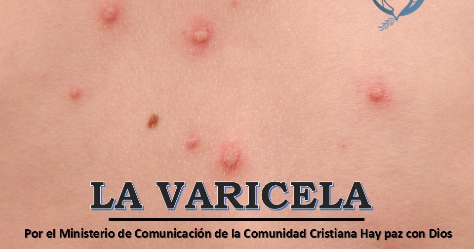 LA VARICELA | C.C. Hay Paz con Dios