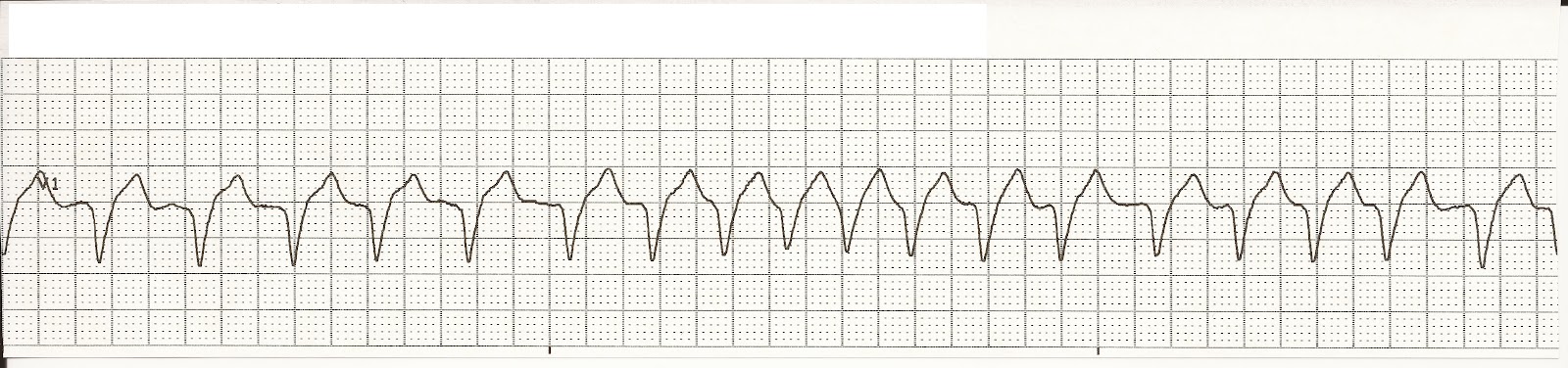 ACLS review: Wide Complex Tachycardia (WCT) Part 1