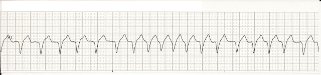 ACLS review: Wide Complex Tachycardia (WCT) Part 1
