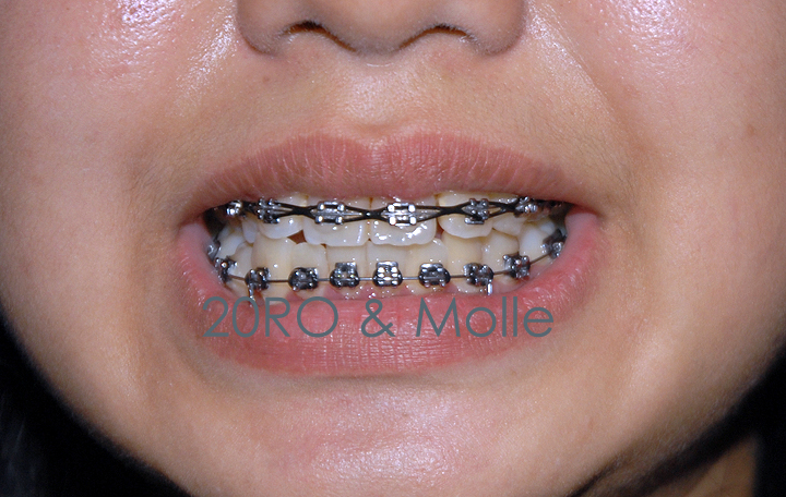 Pasang Behel Gigi Jogjakarta: Pasang Behel Permanen Jogjakarta