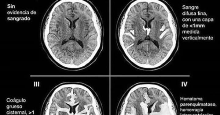 CEREBRA LA VIDA: ESCALA DE FISCHER PARA HEMORRAGIAS ARACNOIDEAS