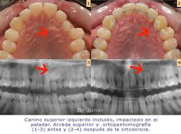 CAUSAS, SÍNTOMAS Y TRATAMIENTO PARA LA ANQUILOSIS DENTAL | MEJORA TU SALUD