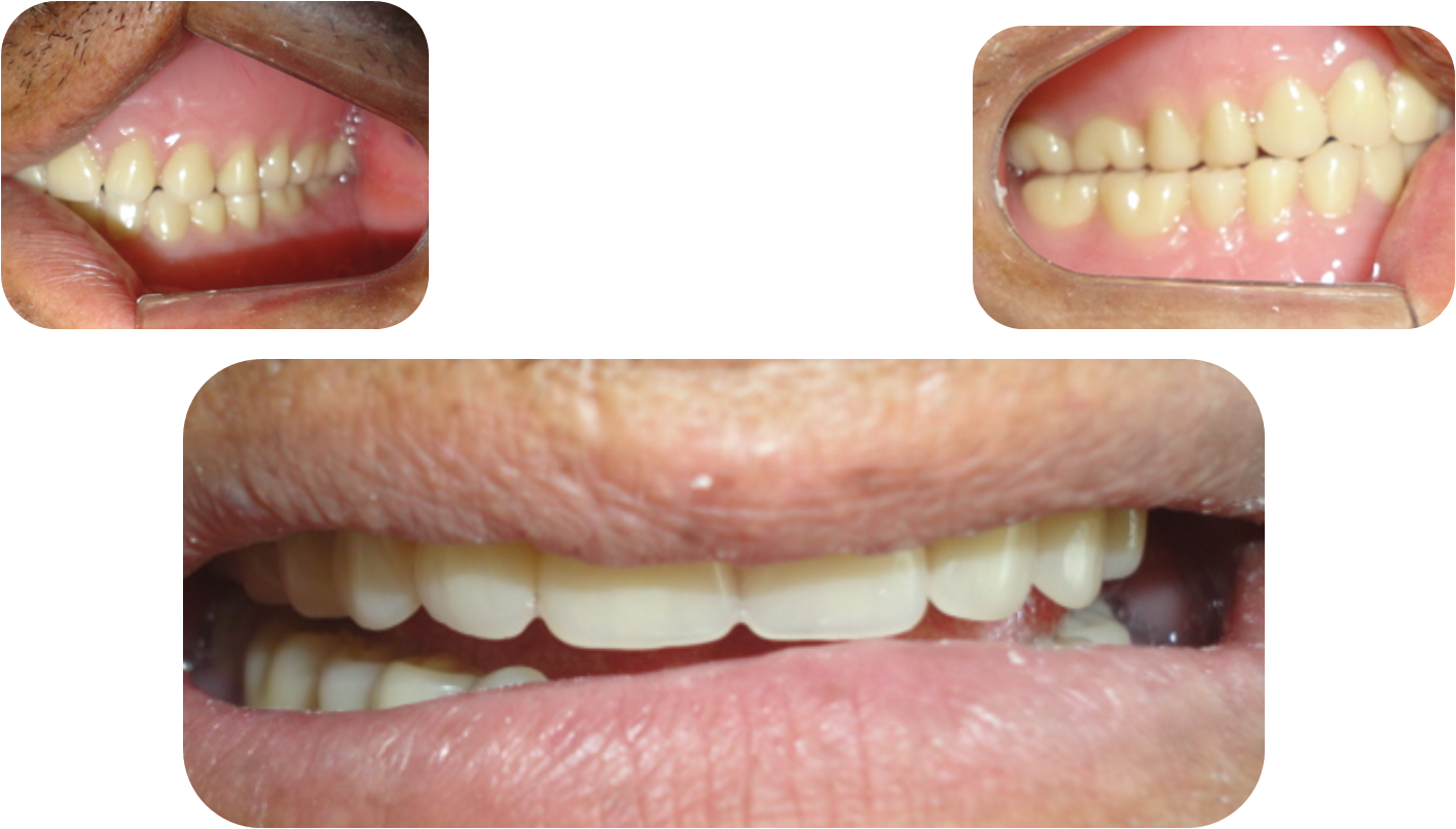 odontologosPerú: Prótesis Total: Zona Neutra