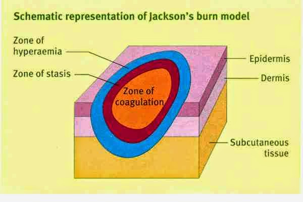 Burn Notice Blog Edition: Welcome and Defining Burns