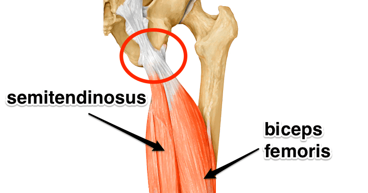 Peter's kitesurfing blog: Recovering from hamstring tendon attachment ...
