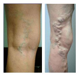 DRA. CRISTIANE MARAN: VARIZES - CONCEITO E CONSIDERAÇÕES GERAIS