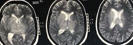 Deep cerebral Venous Thrombosis-MRI - Sumer's Radiology Blog