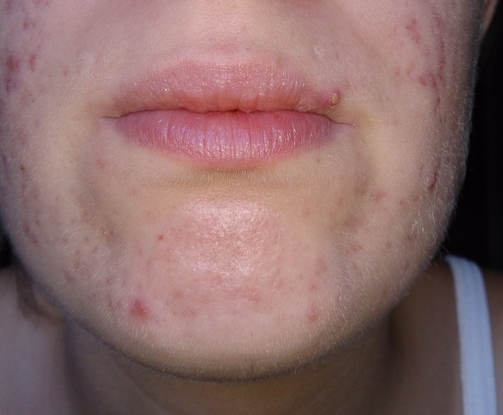 Tratamiento del acné, ese gran enemigo