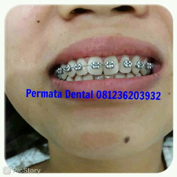 Pasang Gigi Palsu Banyuwangi: Proses Pemasangan Behel | Bracket atau ...