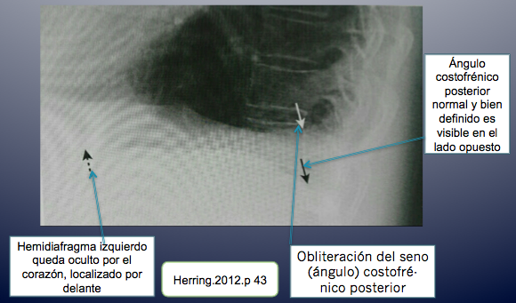 IDENTIFICACIÓN DE UN DERRAME PLEURAL: Obliteración del seno ...