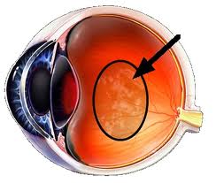 Tipos de Miodesopsias | Miodesopsias o Moscas Volantes Tratamiento