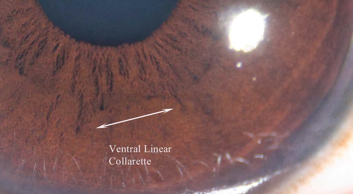 Modern & Multidimensional Iridology: IPB Morphologies, Pupil Flattening ...