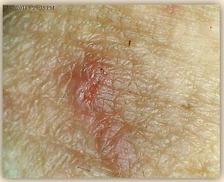 Malassezia Yeast ~ My Story * ~: Malassezia Yeast – ALL PHOTOS (PT 2)