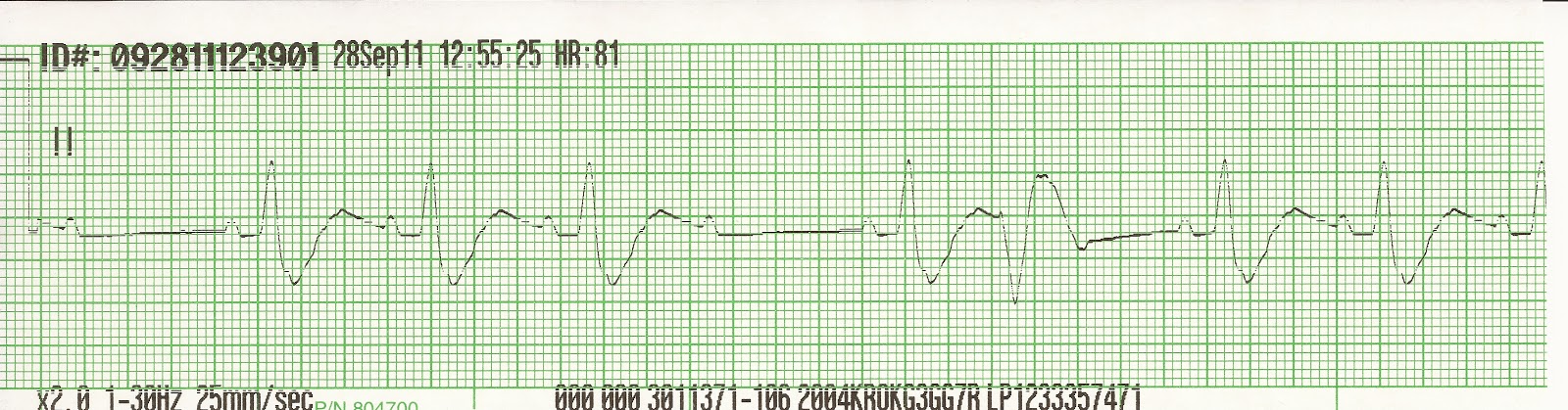 ACLS Rhythms: Heart blocks