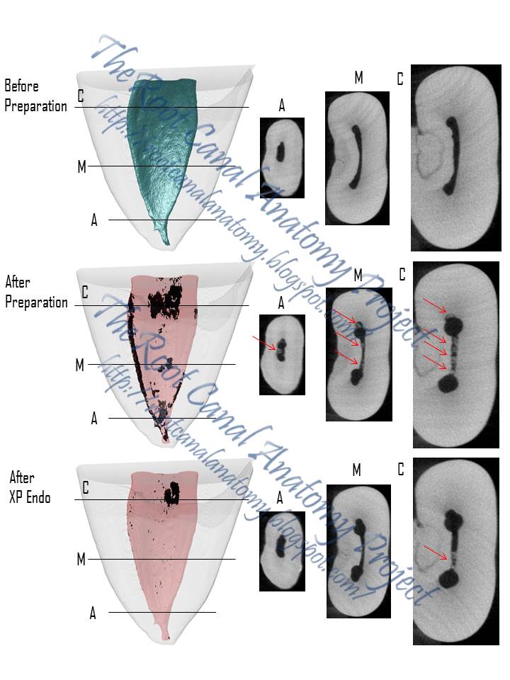 The Root Canal Anatomy Project: Hard Tissue Debris Removal: XP Endo ...