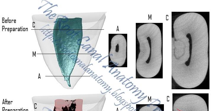 The Root Canal Anatomy Project: Hard Tissue Debris Removal: XP Endo ...