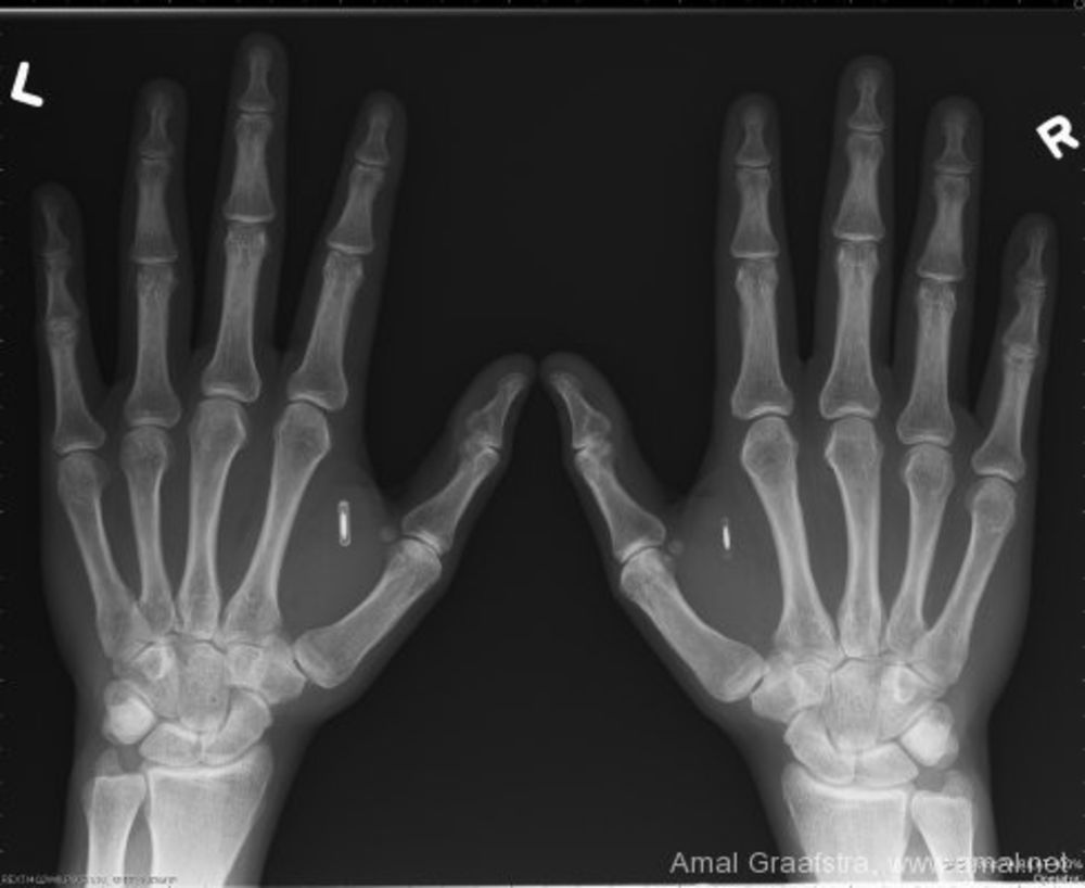 RFID microchip implants on humans will jeopardize their security - RFID ...