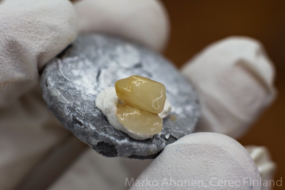 Cerec Finland: Väliaikainen 1-siipinen Maryland-silta (sauman ...