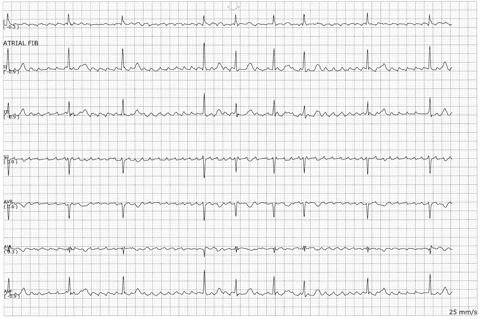 Float Nurse Atrial Flutter With Variable Or Irregular Ventricular Response float-nurse-atrial-flutter-with-variable-or-irregular-ventricular-response