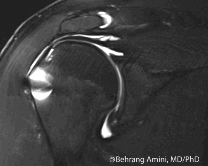 Roentgen Ray Reader: GraftJacket Tendon Repair