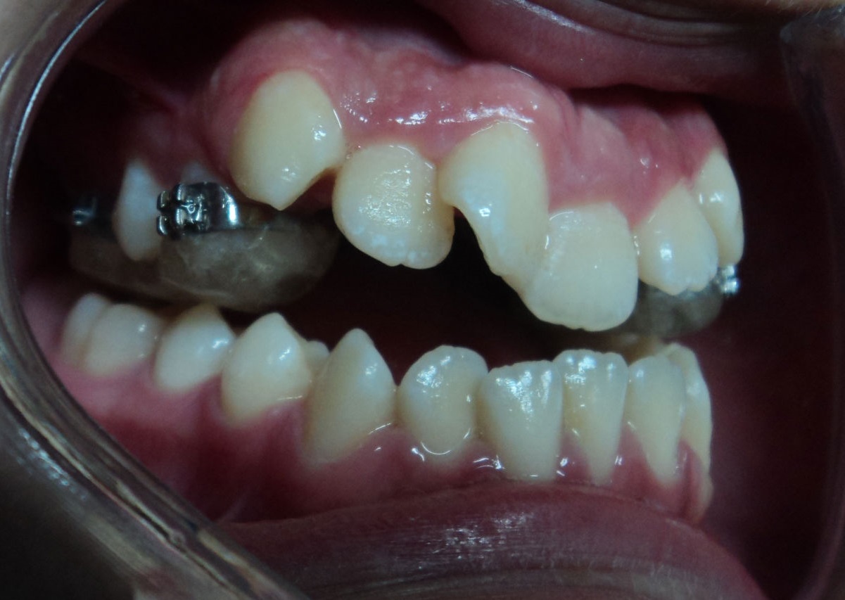 ODONTO-ESTOMATOLOGICA: APARATO DISYUNTOR HIRAX