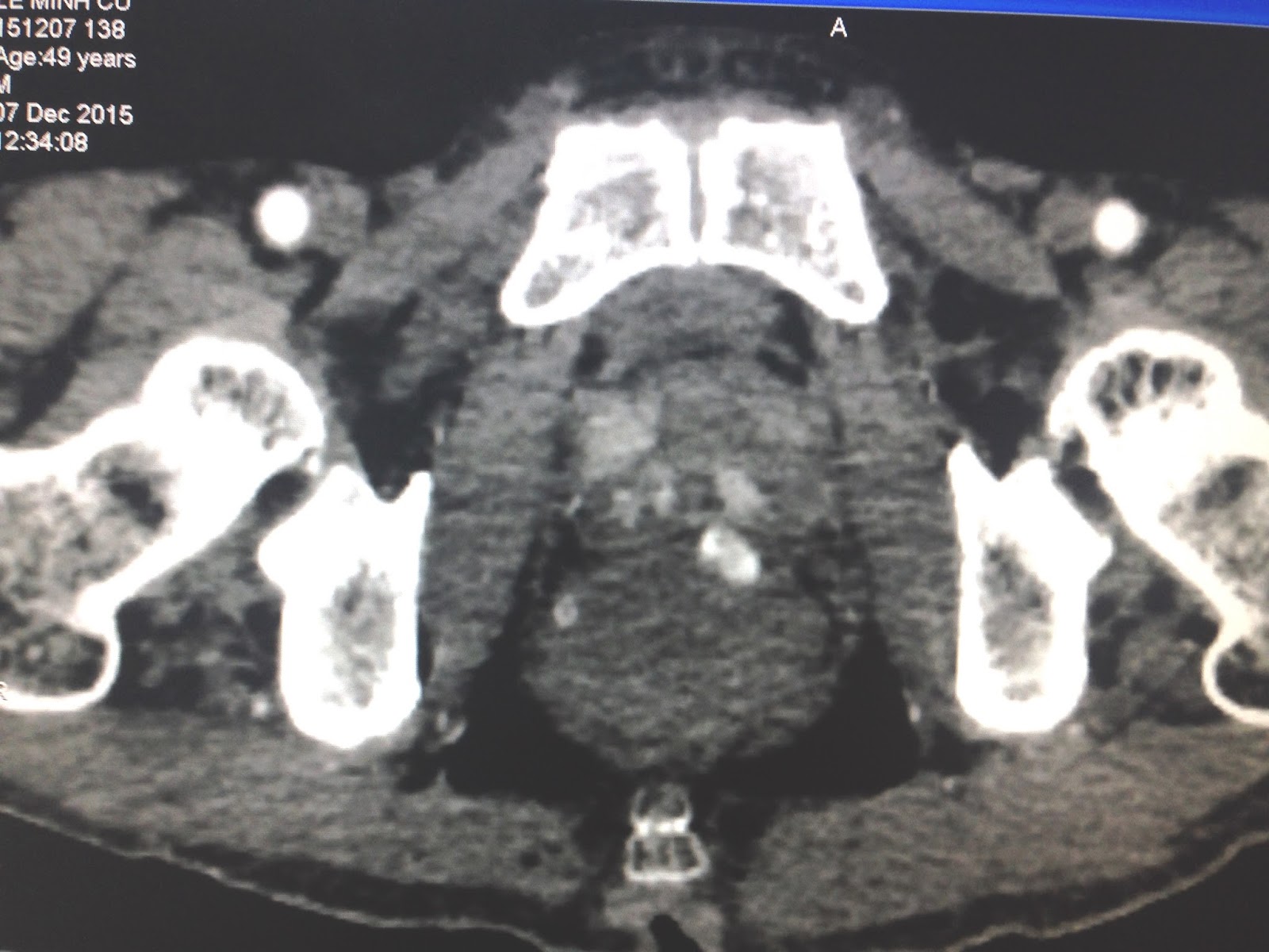 VIETNAMESE MEDIC ULTRASOUND: CASE 352: PROSTATE TUBERCULOSIS, Dr PHAN ...