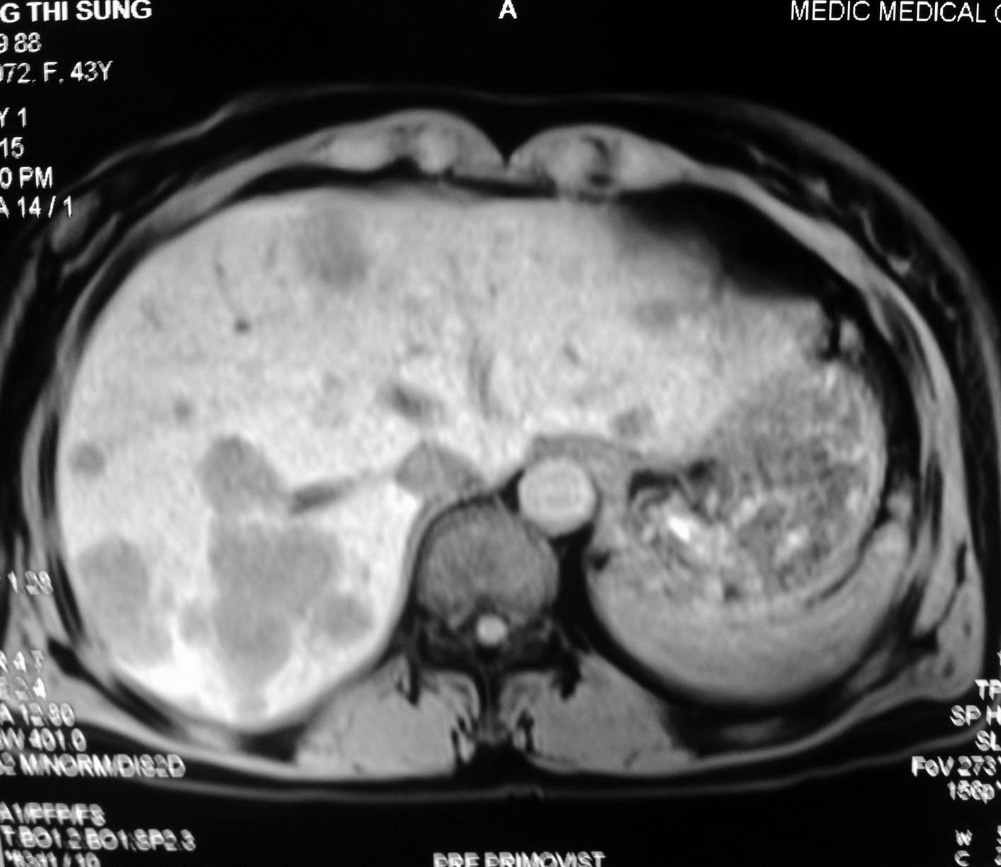 VIETNAMESE MEDIC ULTRASOUND: CASE 334: MULTIPLE HEPATIC TUMORS: Dr PHAN ...