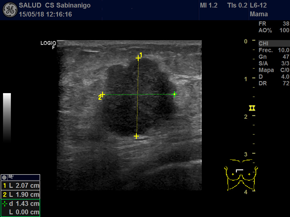 Ecografía en Atención Primaria: Nodulo en MAMA