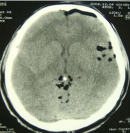 Dr Herry Setya Yudha Utama SpB. FInaCS. MHKes. ICS: Seri Bedah Saraf ...