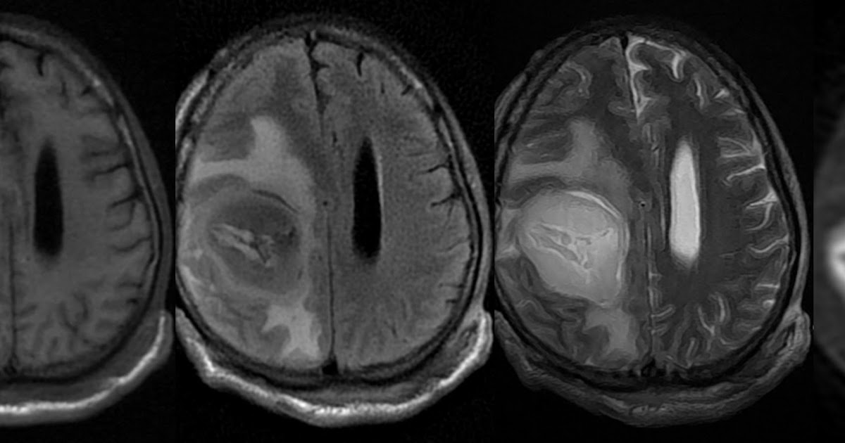 Dr Balaji Anvekar FRCR: Brain Abscess MRI