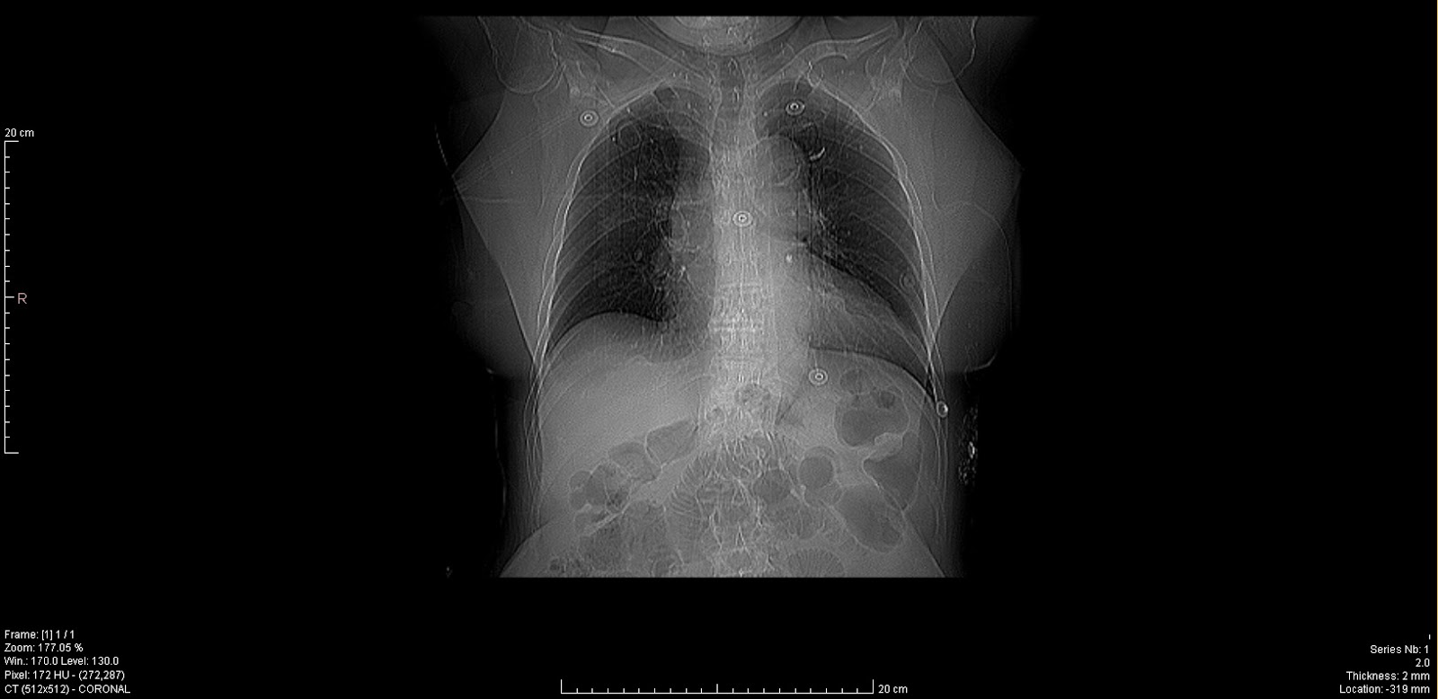 Radiología Fácil: TC-TEP