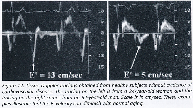 Pedi cardiology: Tissue Doppler Imaging - Mitral Lateral Annulus TDI