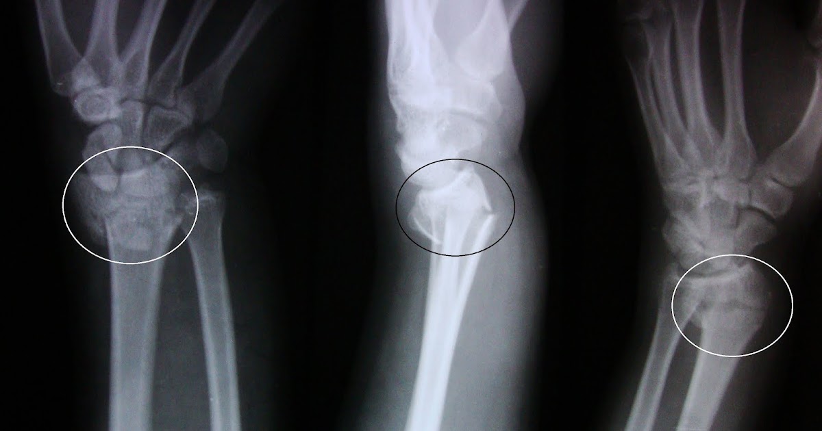 Angulated Bone Fracture Treatment | Surgery | Healing Time