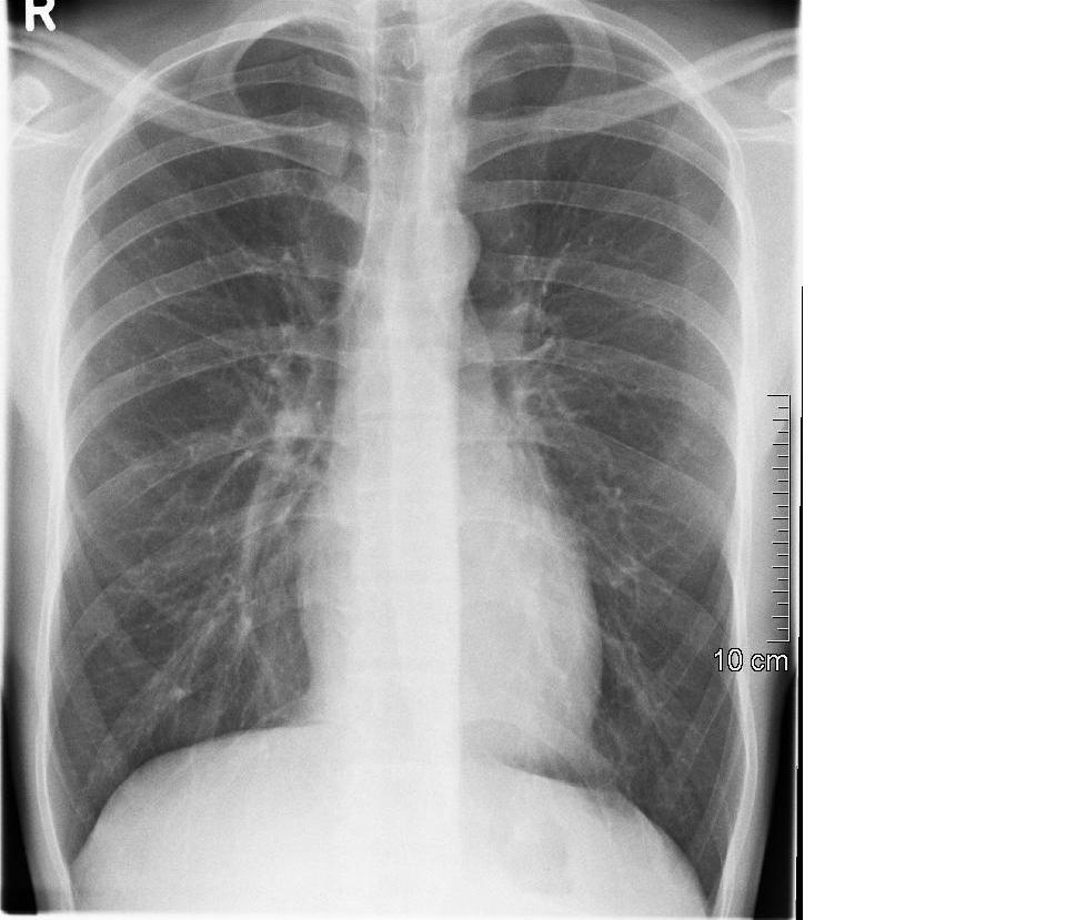 Rheumatologe: Infliximab and Tuberculosis, and case presentation