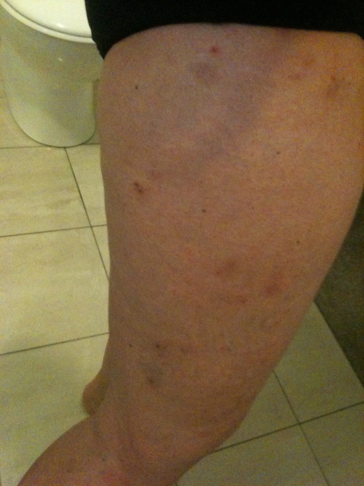 Topical Steroid Withdrawal Journey-Healing Eczema and Red Skin Syndrome ...