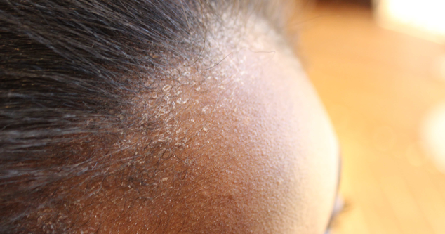 Reasons why you might be having dry scalp - African Naturalistas