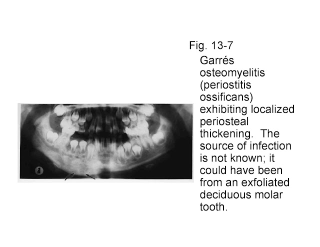 Dentistry and Medicine: Osteomyelitis-with Radiological features