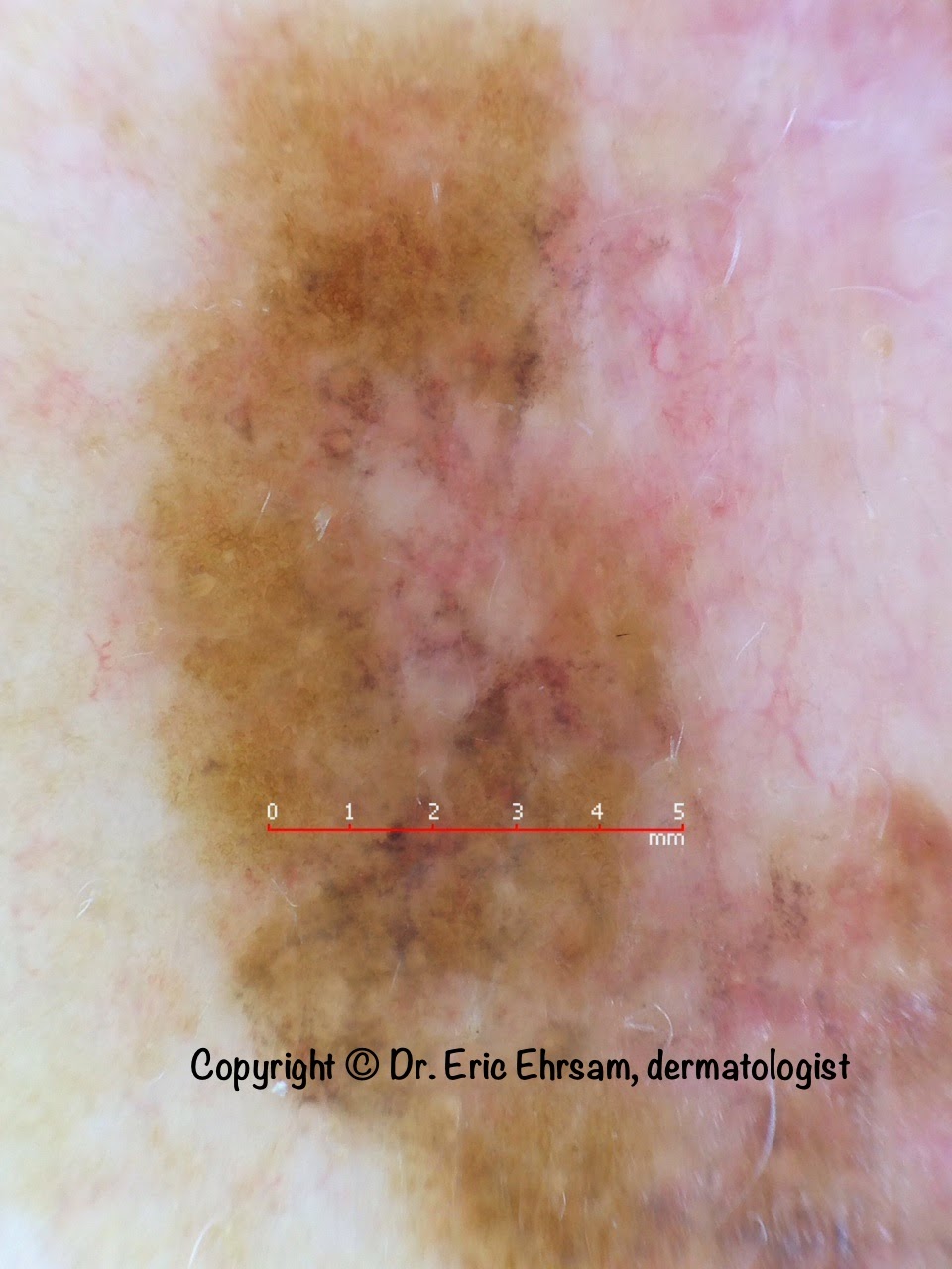 dermoscopy: Regression