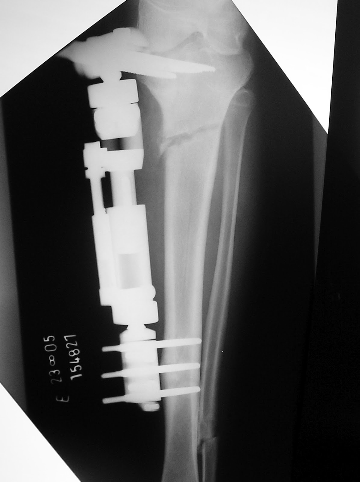 DR. CELSO RIZZI: Osteotomia de abertura gradual da tíbia proximal ...