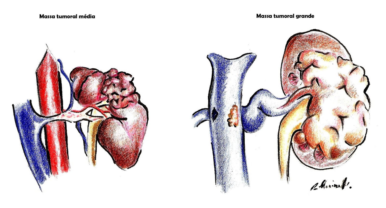 Blog do Câncer Renal